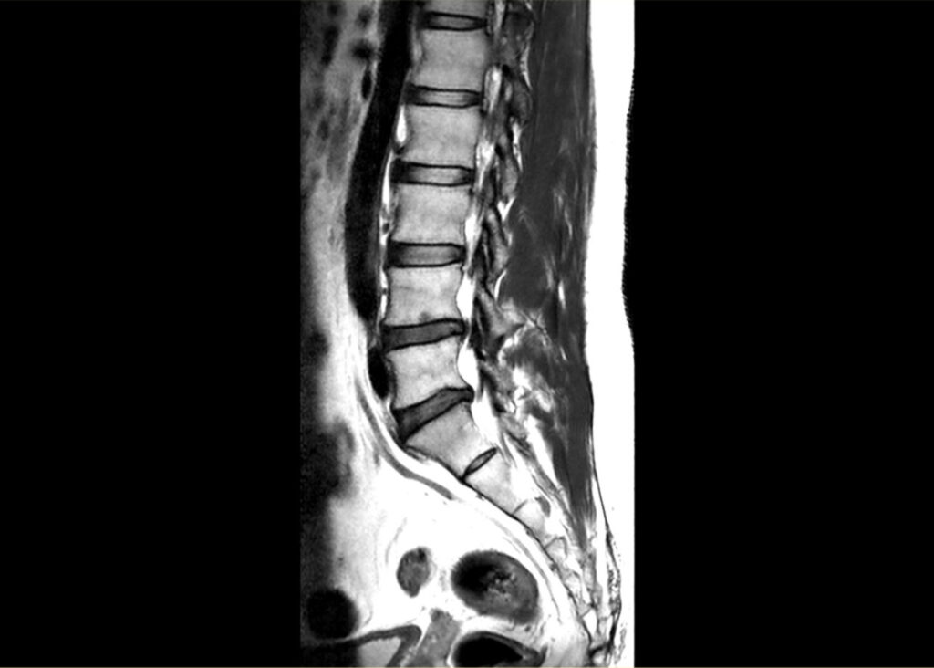 Spinal Canal Endoscopy: An Insight into Advanced Diagnostic and ...