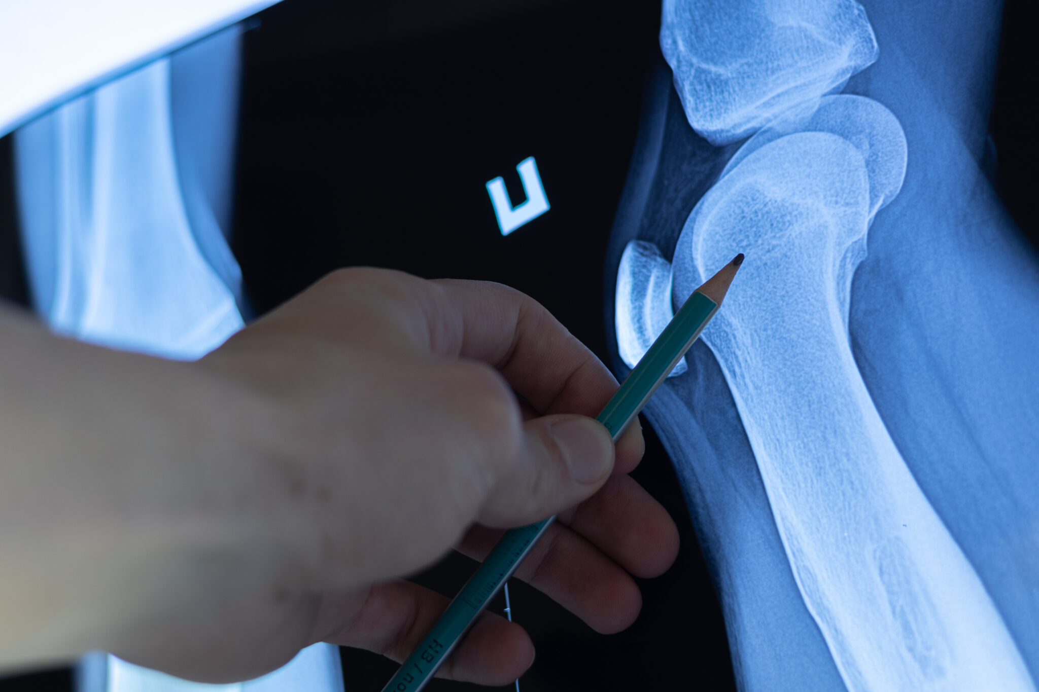 The Link Between Low Bone Density and Arthritis - Urban Spine and Joint